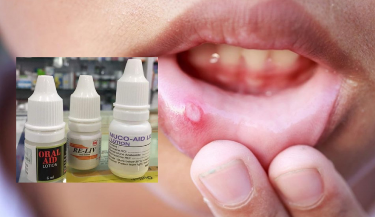 Senarai Ubat Rawat Ulser Mulut Yang Anda Boleh Beli Di Farmasi Agar ...