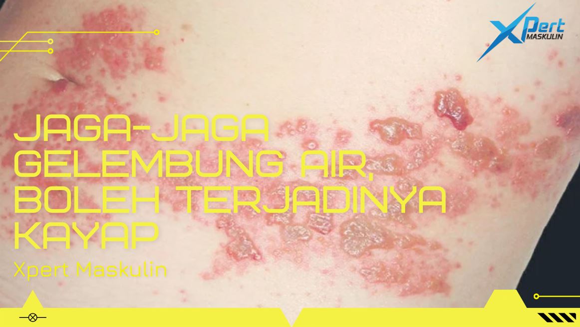 Jaga-Jaga Gelembung Air, Boleh Terjadinya Kayap - Maskulin