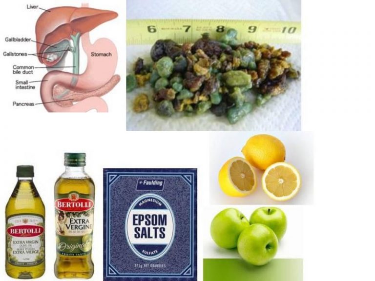 Hilangkan Penyakit Batu Hempedu Tanpa Lakukan Pembedahan, Lelaki Ini ...