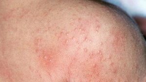 Alergi Air Aquagenic Urticaria (AU) Umpama HFMD? - MASKULIN
