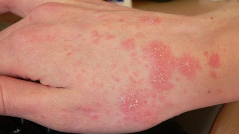 Apa Itu Kudis Buta? Mengapa Seseorang Itu Terkena Kudis Buta? Ini ...